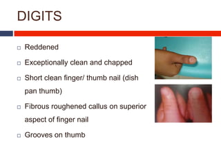 Oral Habits in Children. Part 1: Thumb sucking and Mouth Breathing | PPTX