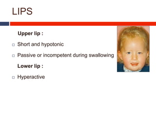 Oral Habits in Children. Part 1: Thumb sucking and Mouth Breathing | PPTX