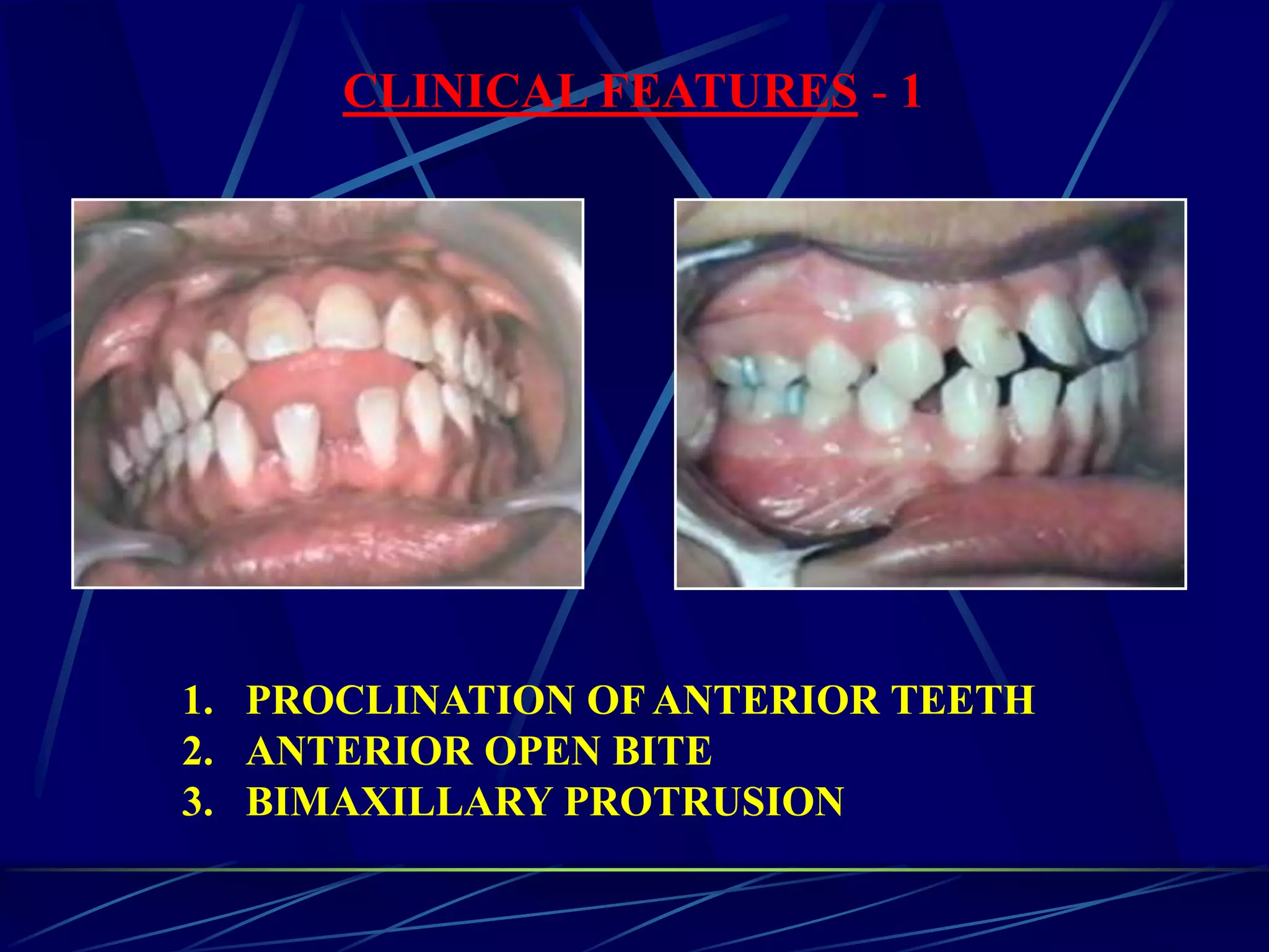 Habits in Orthodontics | PPT