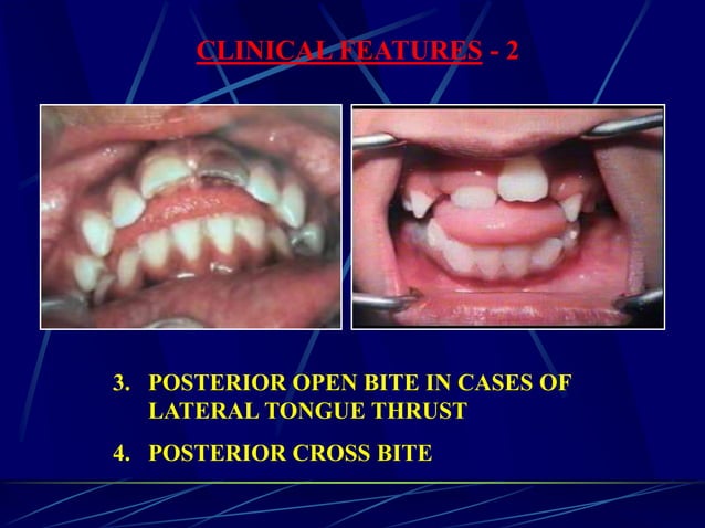 Habits in Orthodontics | PPT | Dental Health | Diseases and Conditions