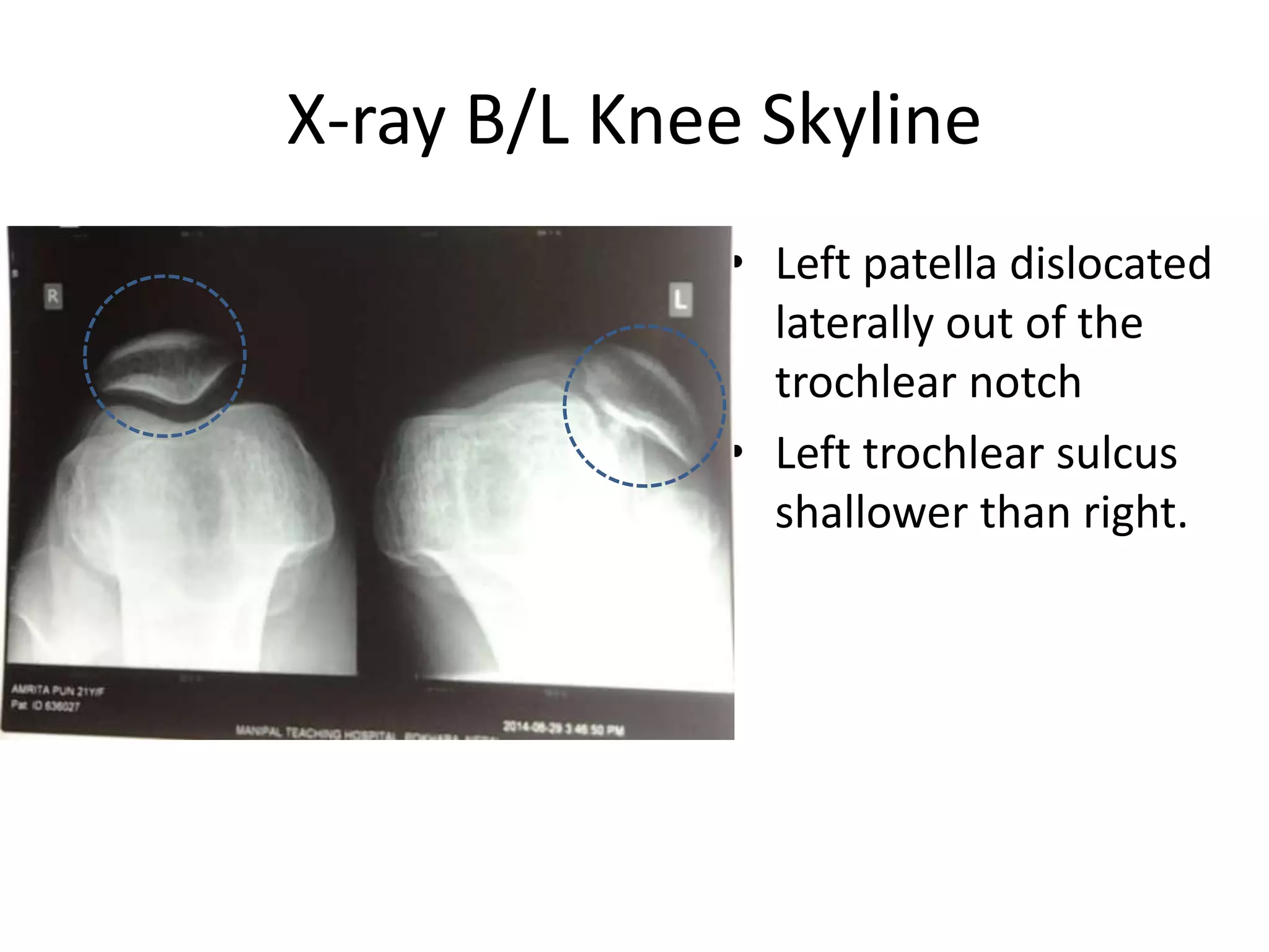 Habitual dislocation of patella | PPTX