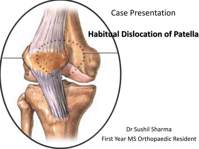 Habitual dislocation of patella | PPTX