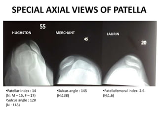 Habitual dislocation of patella | PPTX