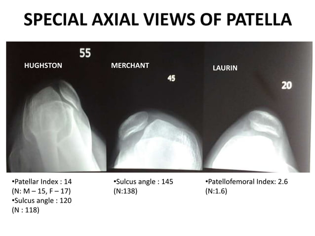 Habitual dislocation of patella | PPT | Free Download