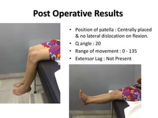 Habitual dislocation of patella | PPT