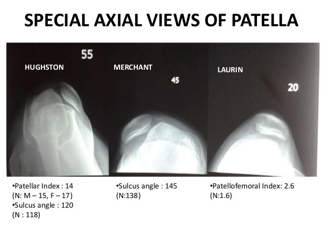 Habitual dislocation of patella