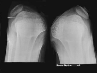 Habitual dislocation patella | PPTX