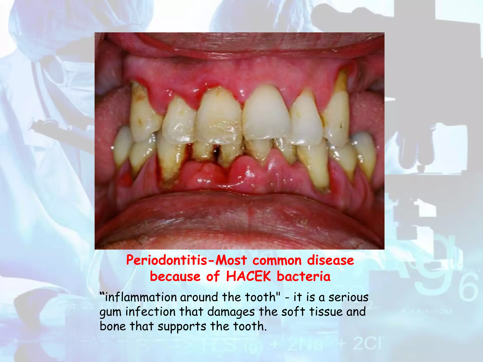 Hacek report iin bacte | PPTX