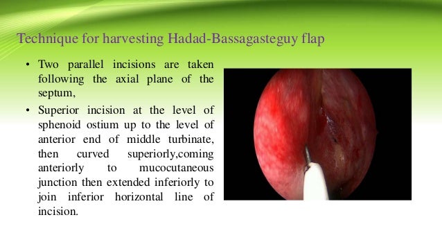 Hadad.bassagasteguy flap