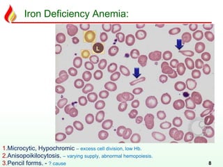 Haem12: Deficiency anemias | PPT