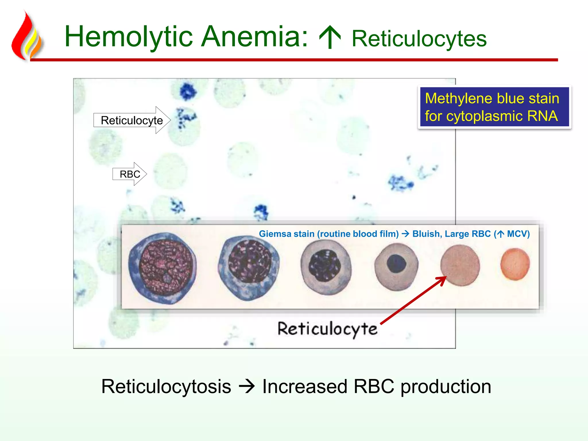 Anemia3 Hemolytic acquired | PPTX