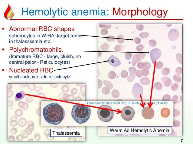 Anemia3 Hemolytic acquired