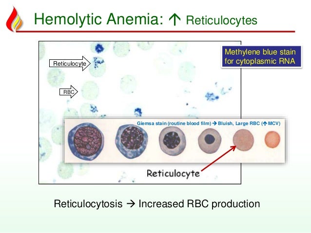 Anemia3 Hemolytic acquired