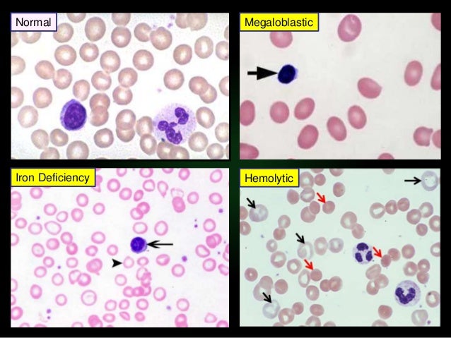Anemia5 anemias minor