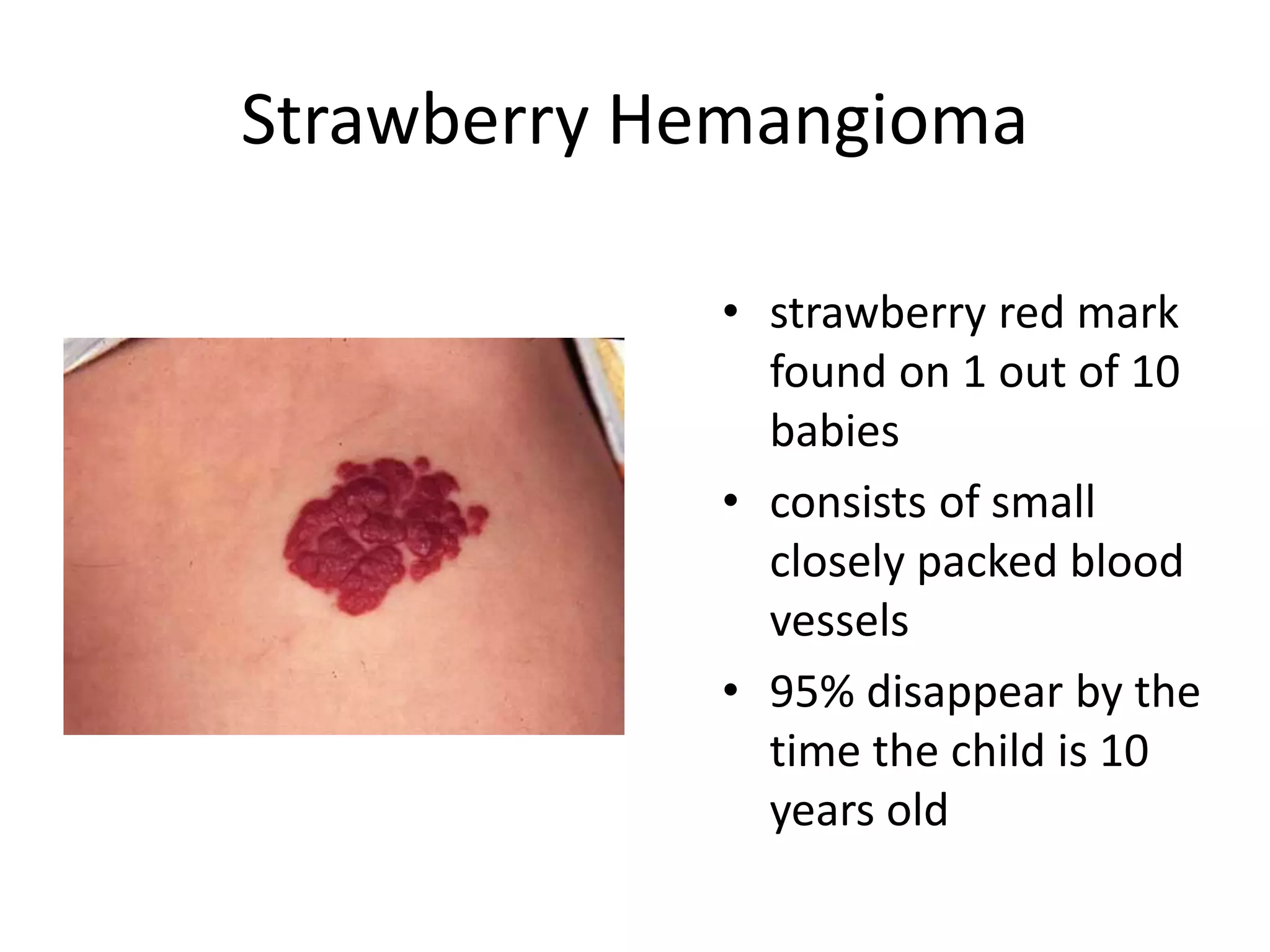 Intramuscular haemangioma | PPT