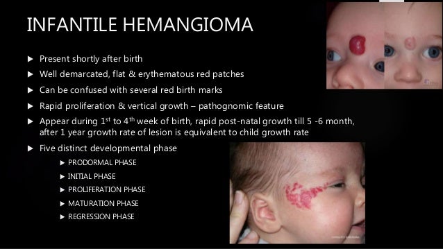 Haemangioma and vascular anomelies