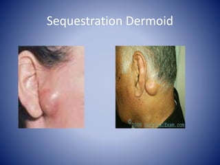 Haemangioma , lymphangioma and dermoid cyst | PPTX