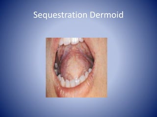 Haemangioma , lymphangioma and dermoid cyst | PPTX