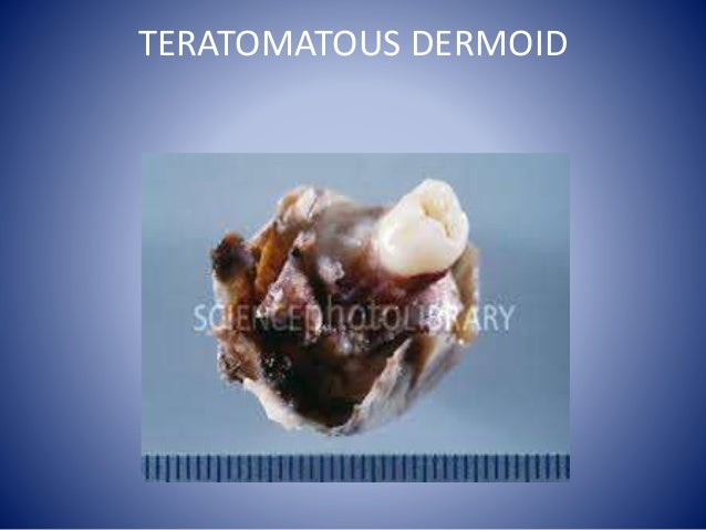 Haemangioma , lymphangioma and dermoid cyst