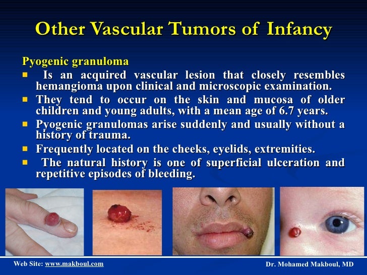 Haemangiomas And Vascular Malformations