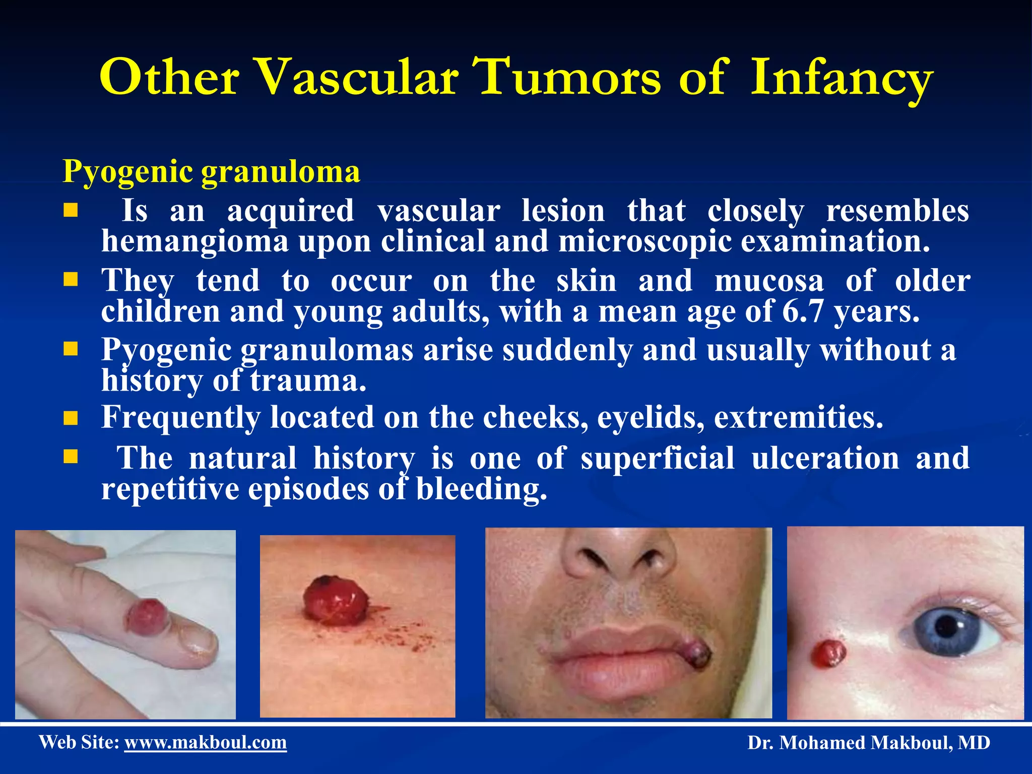 Haemangiomas and vascular malformations | PPTX