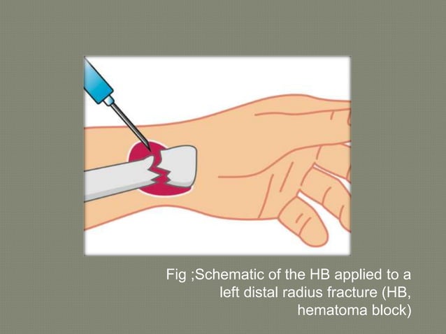 Haematoma block