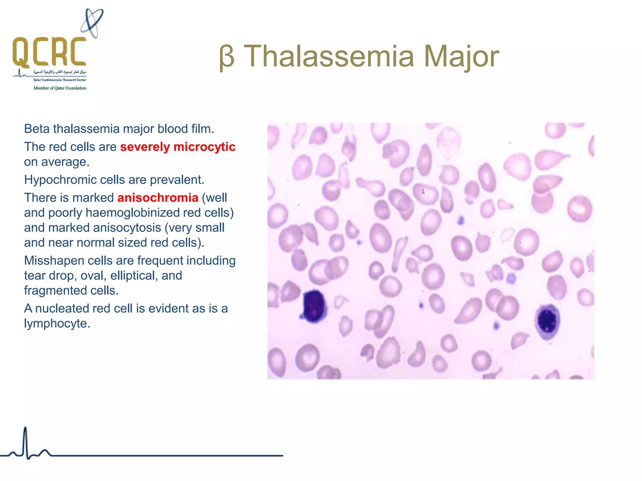 Haematopathology: Introducing the various types of anaemias and red ...
