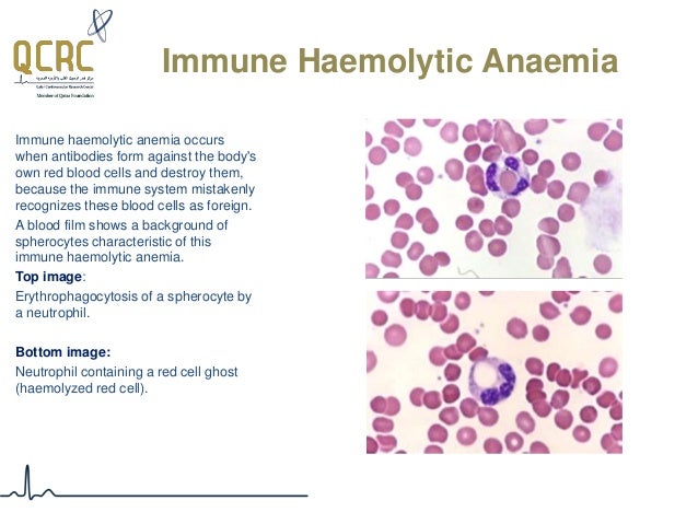 Haematopathology: Introducing the various types of anaemias and red…