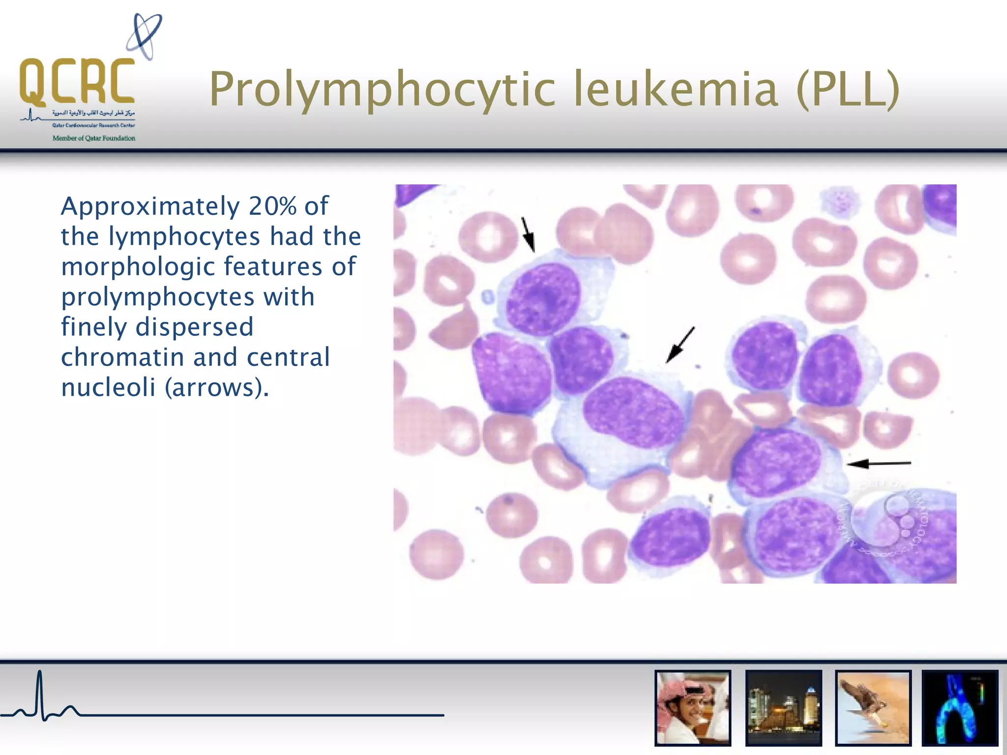 Haematopathology: an introduction to lymphoid neoplasms | PPT