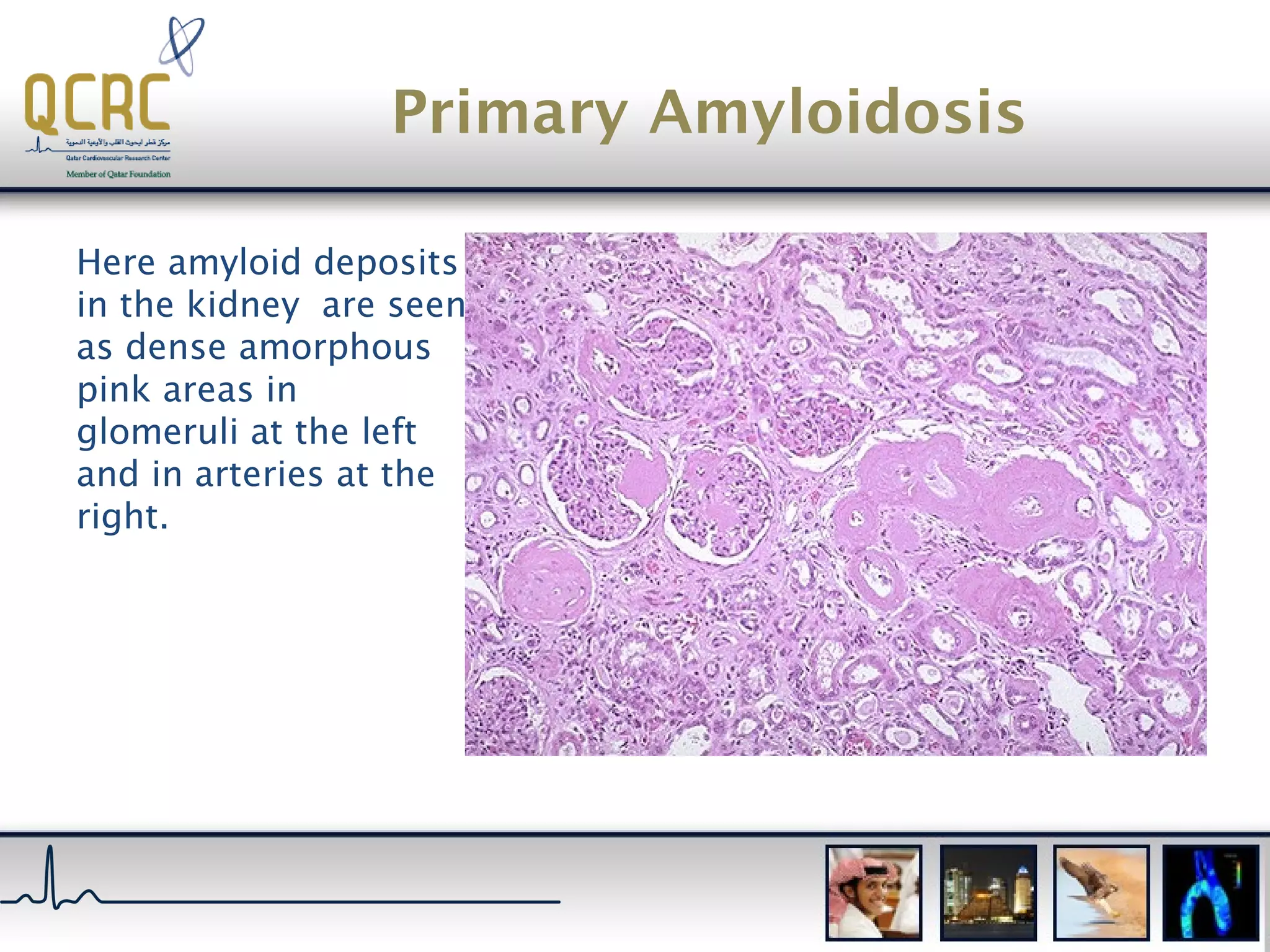 Haematopathology: an introduction to lymphoid neoplasms | PPT