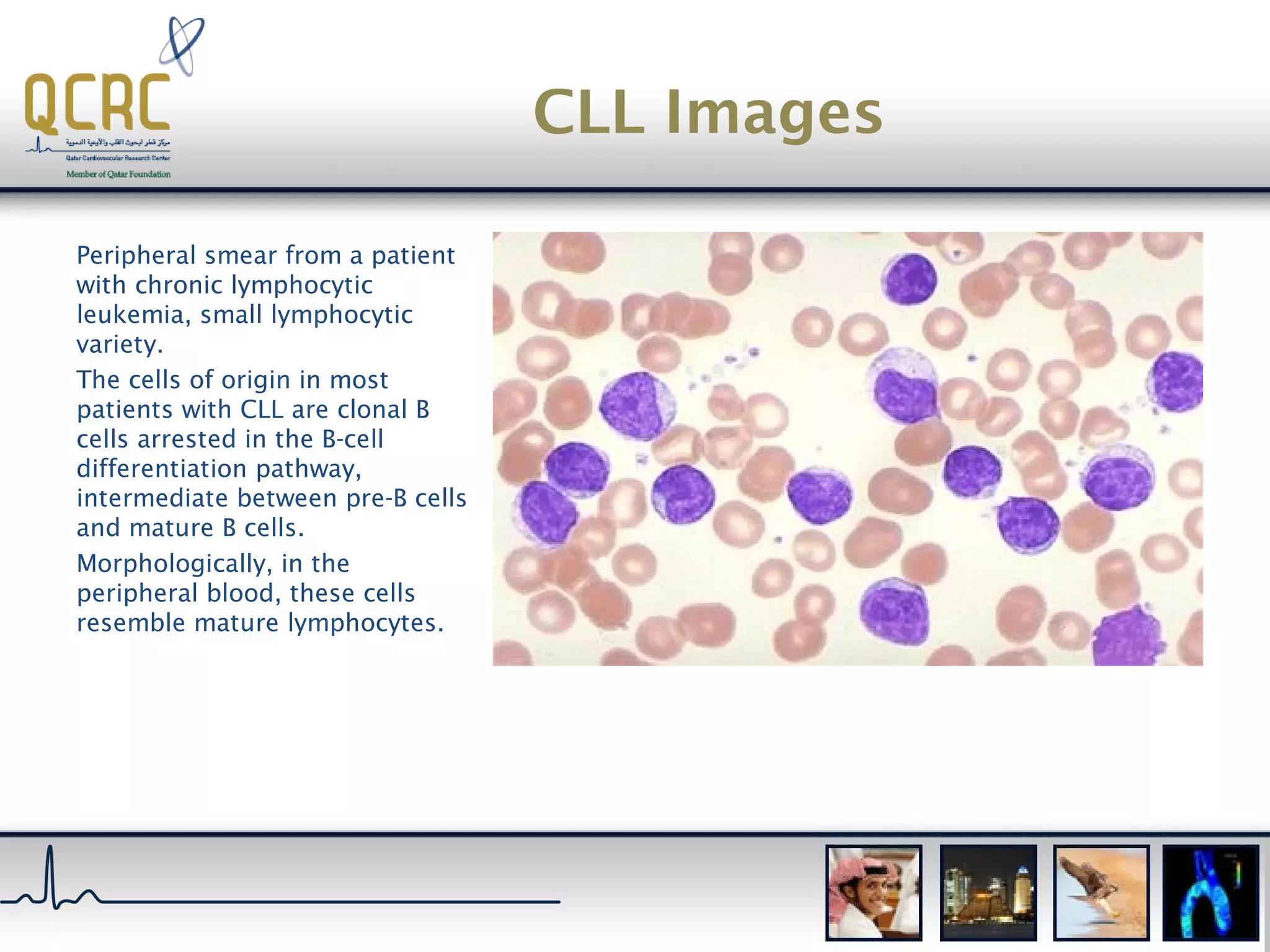 Haematopathology: an introduction to lymphoid neoplasms | PPT