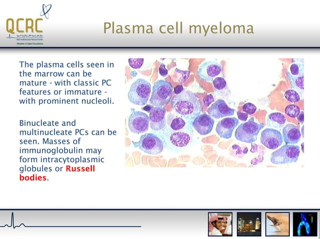 Haematopathology: an introduction to lymphoid neoplasms | PPT