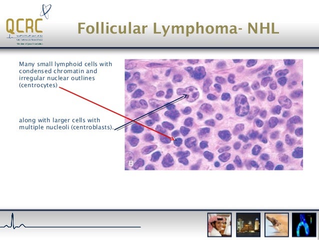 Haematopathology: an introduction to lymphoid neoplasms