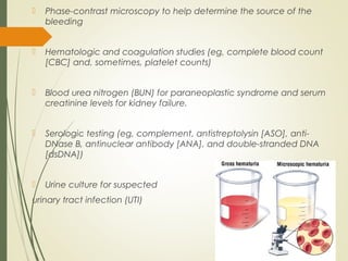 Haematuria | PPT