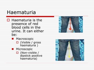 haematuria.ppt