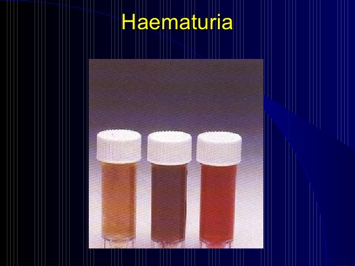 Haematuria & Renal Failure