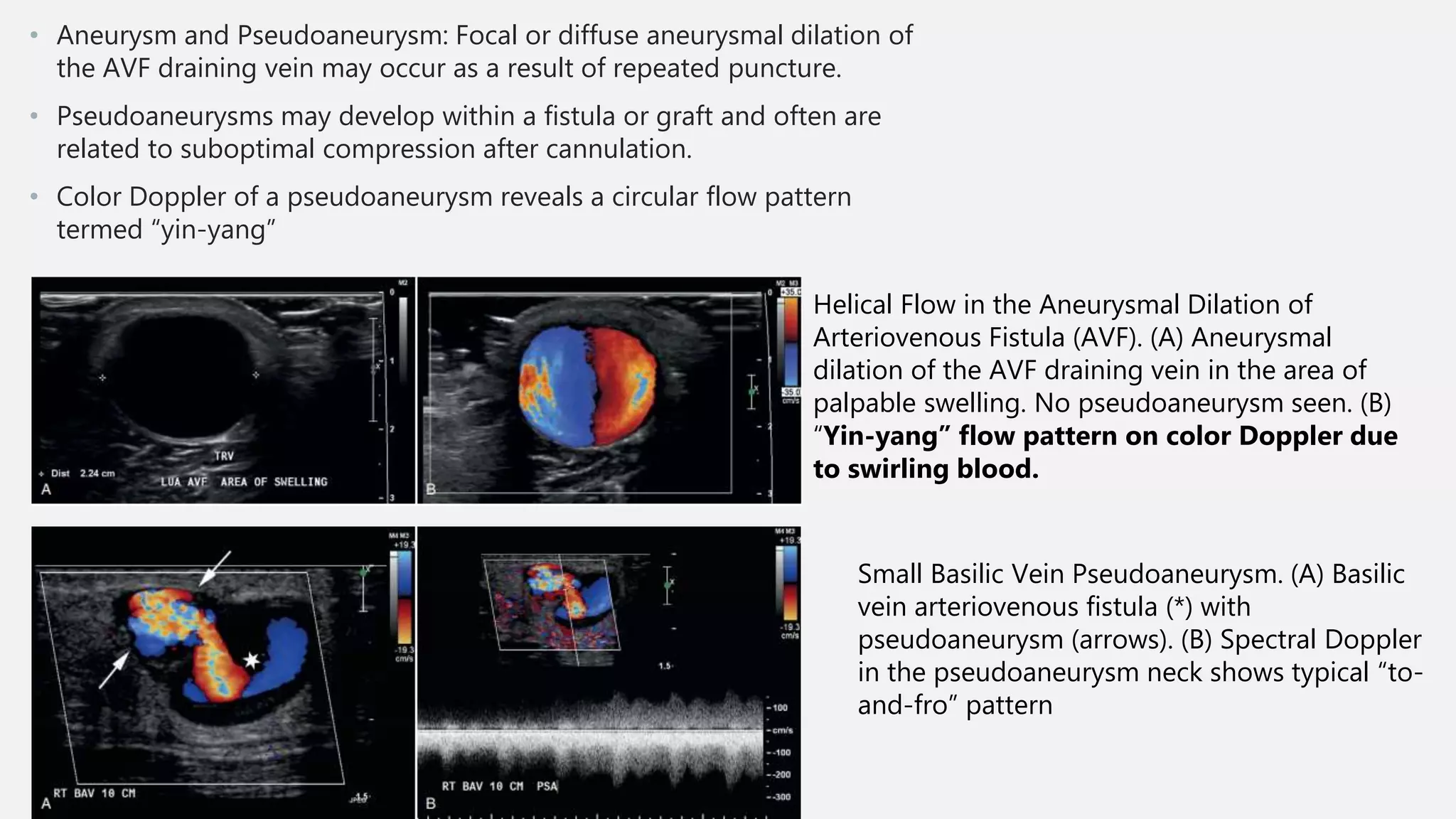 Haemodialysis fistula doppler | PPTX