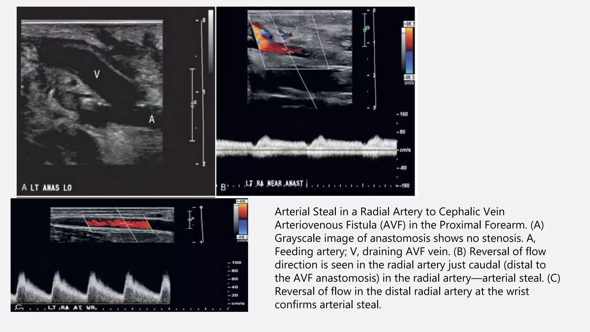 Haemodialysis fistula doppler | PPTX