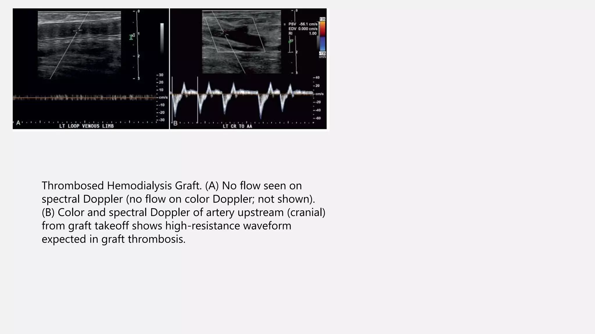 Haemodialysis fistula doppler | PPTX