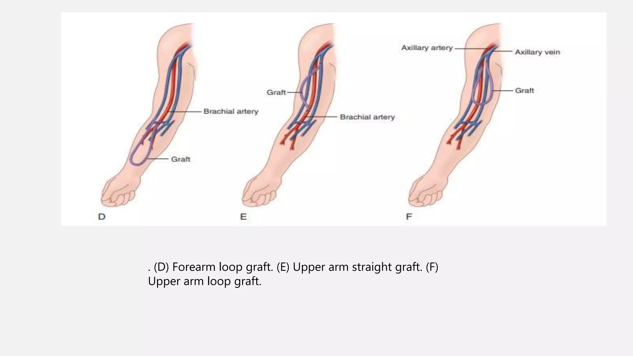 Haemodialysis fistula doppler | PPTX