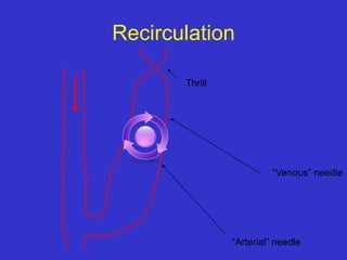 Haemodialysis Fistula Intervention - Dr Ralph Jackson.ppt