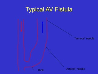 Haemodialysis Fistula Intervention - Dr Ralph Jackson.ppt