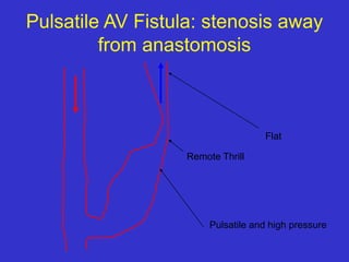 Haemodialysis Fistula Intervention - Dr Ralph Jackson.ppt