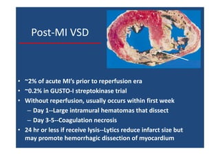 Haemodynamic Instability in STEMI | PDF