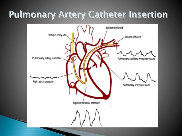Haemodynamic monitoring during cpb | PPTX