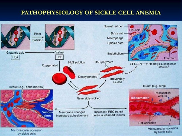 Haemoglobinopathies sickle cell anemia