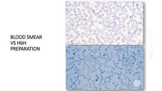 HAEMOGLOBINOPATHIES PART 1 (ALPHA THALASSAEMIA) | PPT
