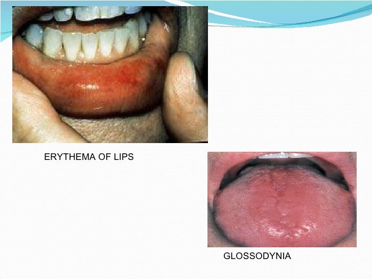 Haemolytic Anaemias in dentistry