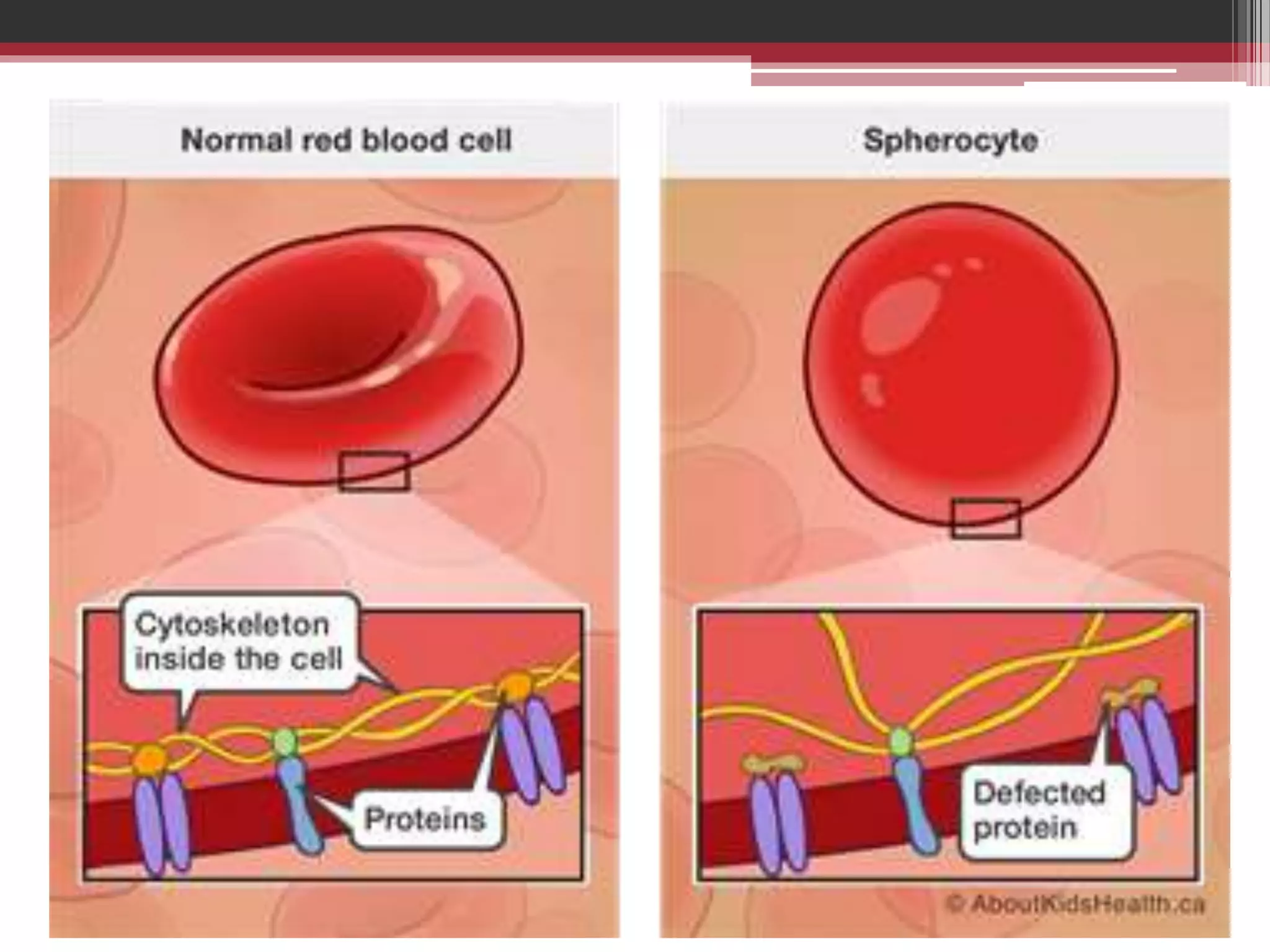 Haemolytic anemias due to cell membrane defects | PPT