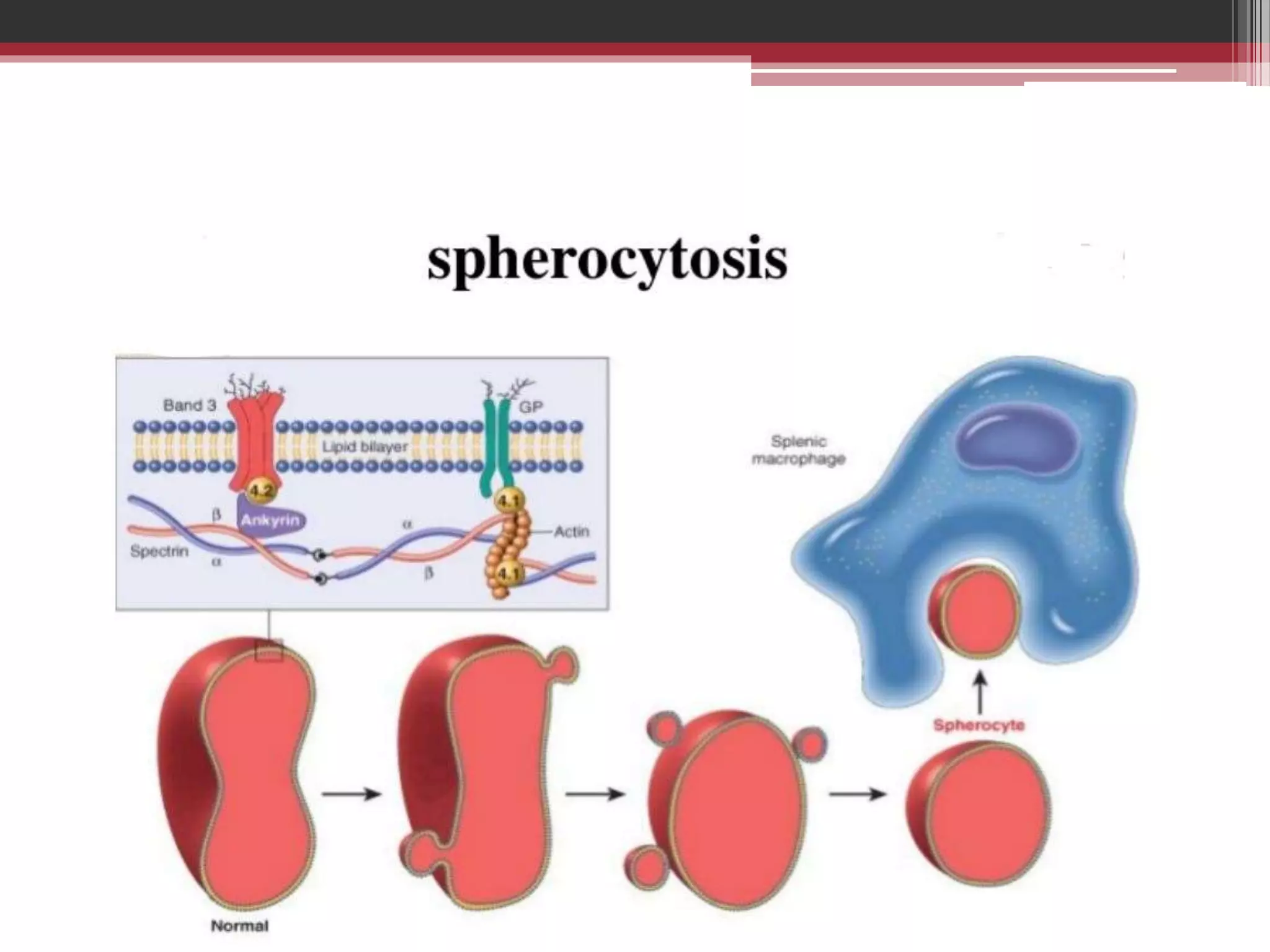 Haemolytic anemias due to cell membrane defects | PPT